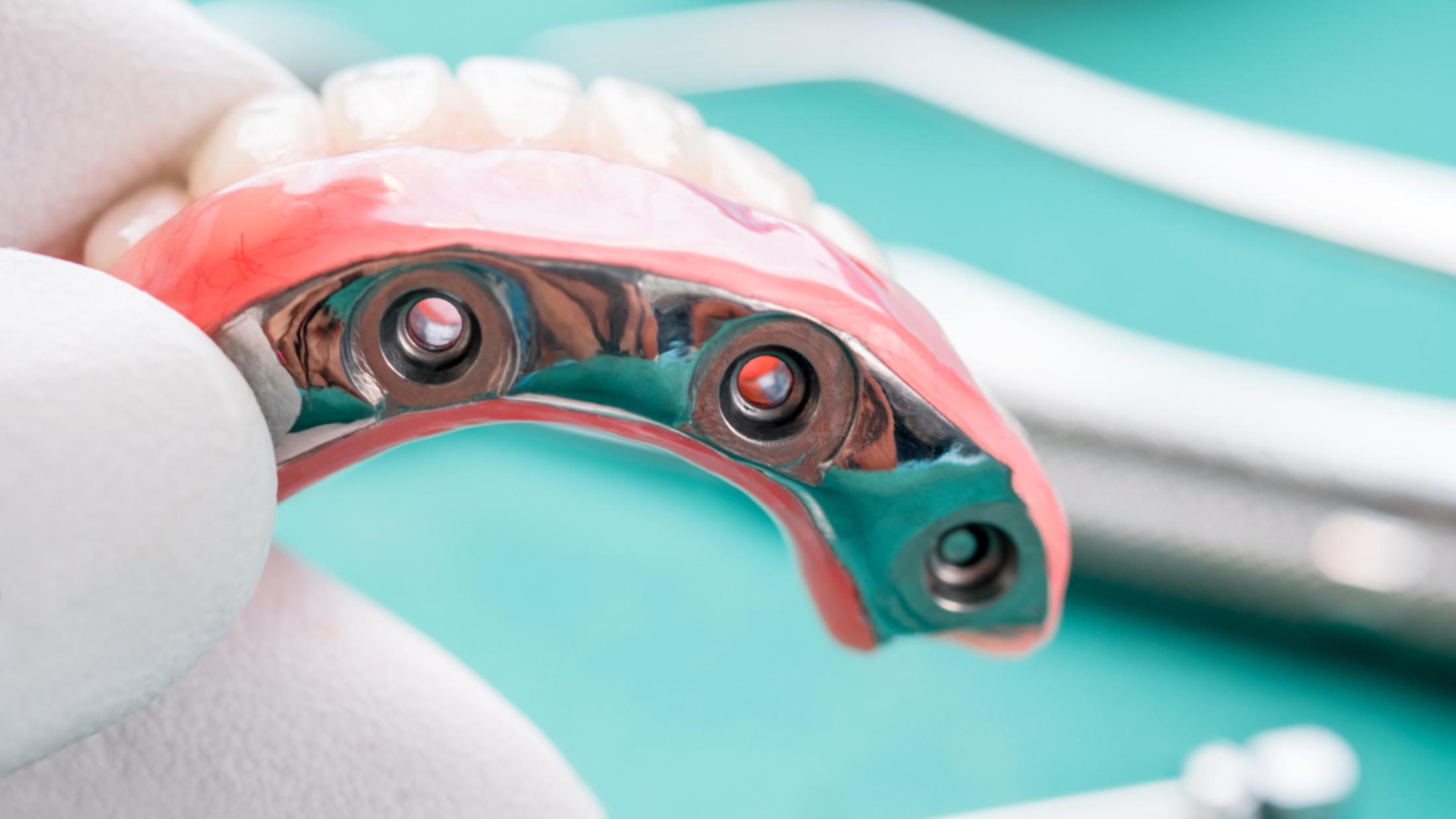 Full-Arch Dental Implants Schererville IN, Jay Platt, DDS, PC