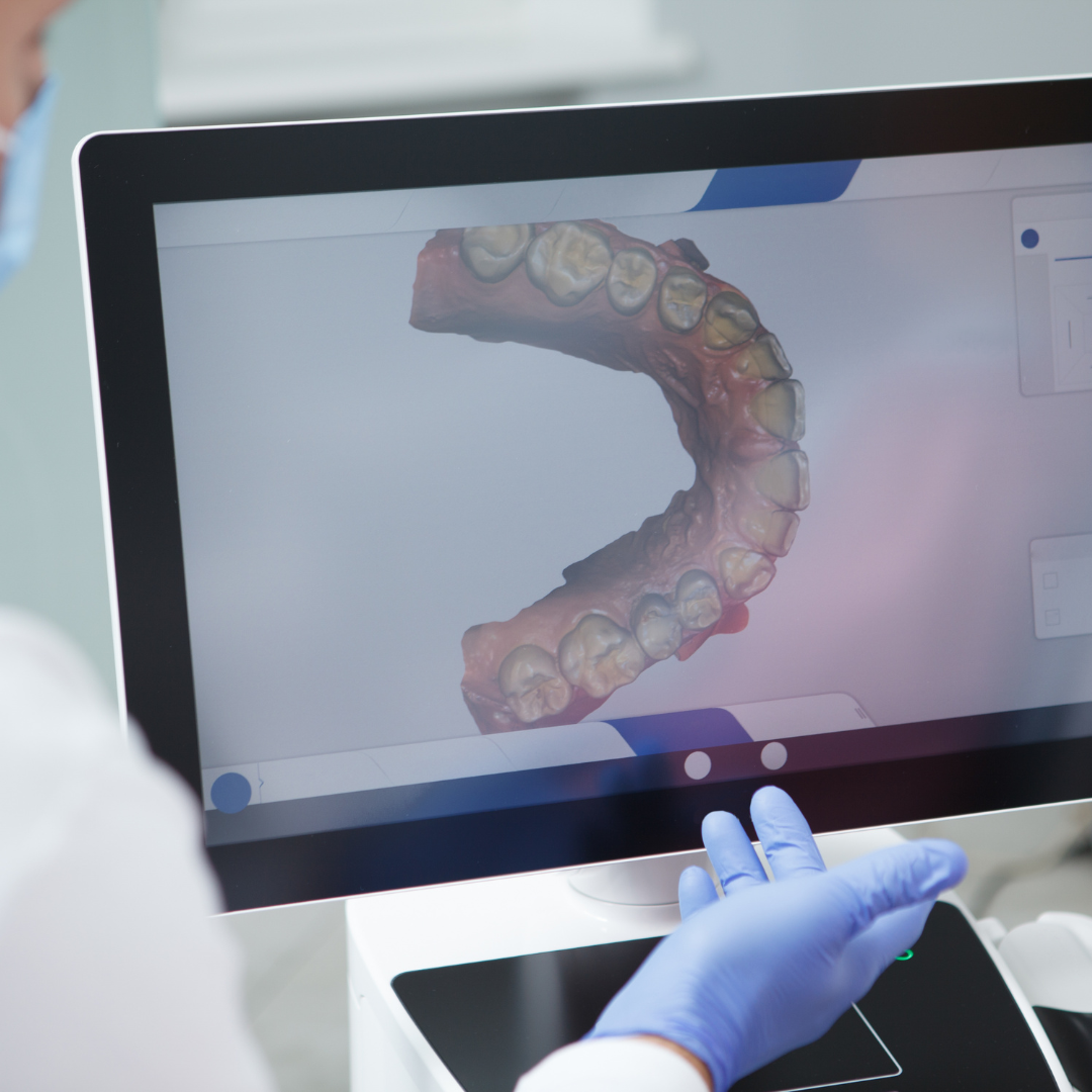 The Benefits of Digital Workflows for Full Arch Dental Implant Procedures